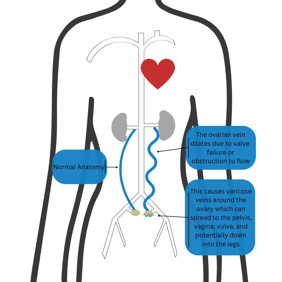 Gonadal Vein Reflux / Pelvic Venous Congestion Syndrome (PVCS) - TRA Endovascular
